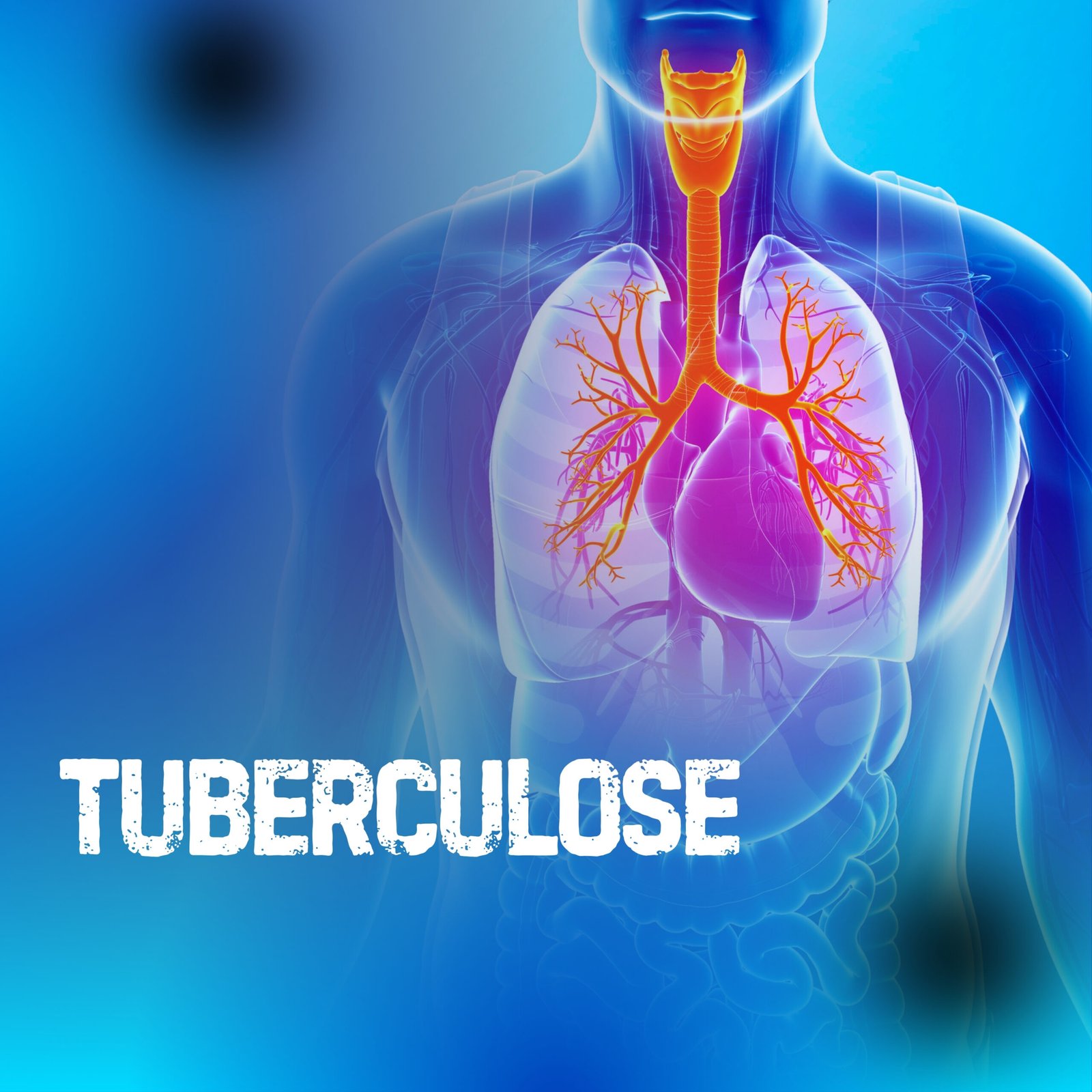 DOENÇAS TROPICAIS: TUBERCULOSE